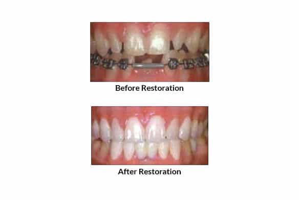 Full Mouth Reconstruction → Restoration Dentistry
